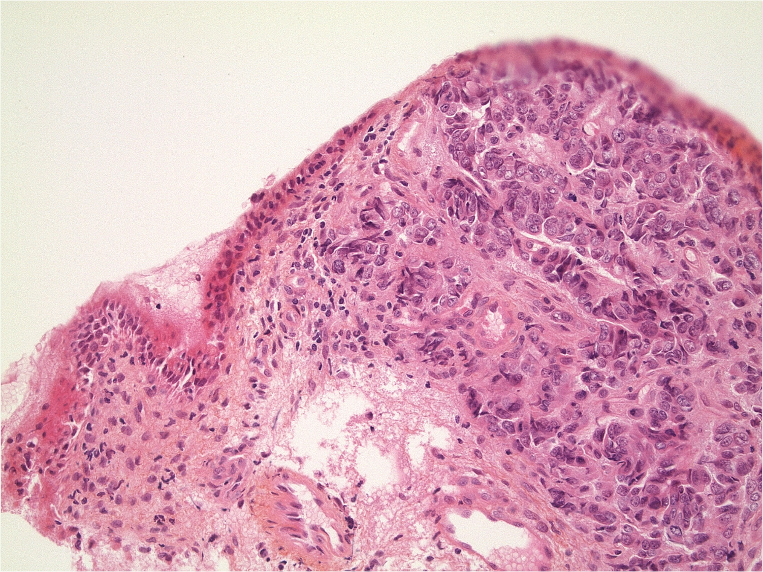 Revue n°90 - Septembre 2012 - Les cancers invasifs de l'endocol - Syngof